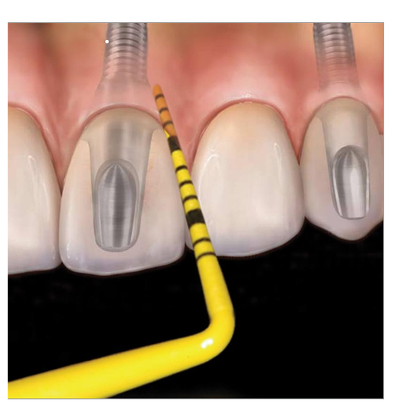 Plastic Tip Probe – John Dental Supplies Inc